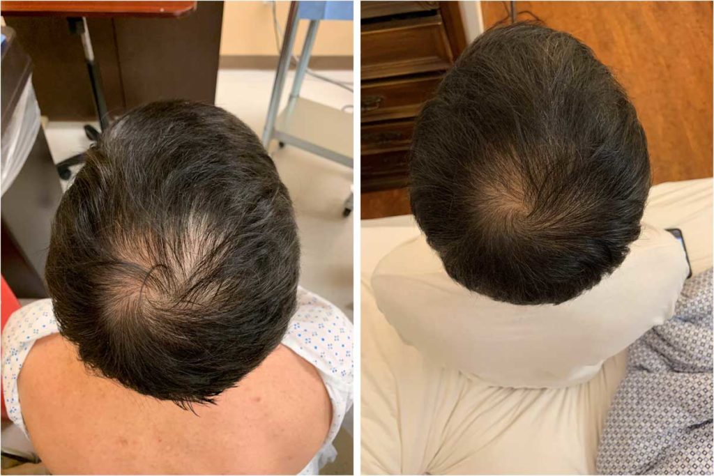 PRP Hair Treatment Results | Regene Spine