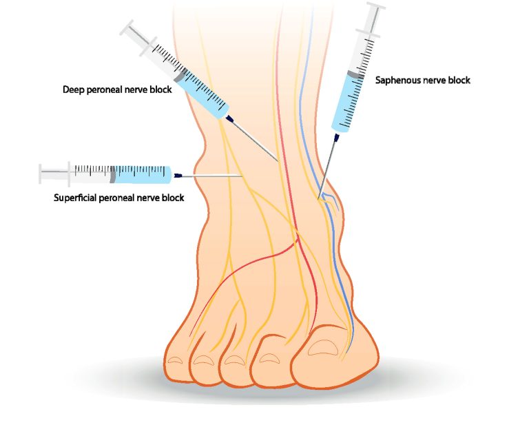 Diagnostic Nerve Blocks: Regenespine